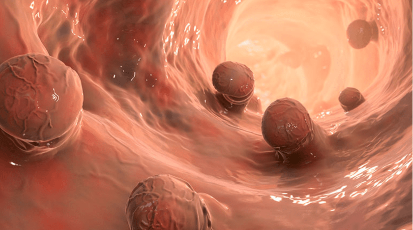 How Colon Polyp Size, Shape and Growth Pattern Affect Cancer Risk ...